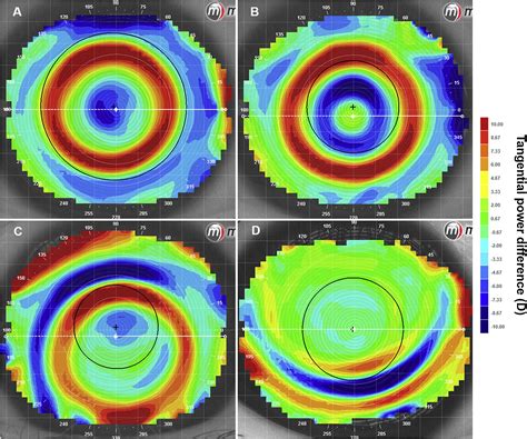 Bcla Clear Orthokeratology Contact Lens And Anterior Eye