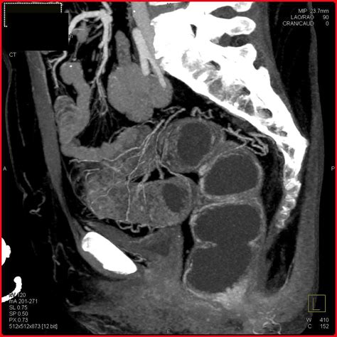 Pancolitis Nicely Seen In 3d Vrt With Large Rectal Varices Colon