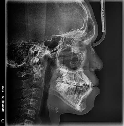 What Should I Do With My Underbite R Orthotropics