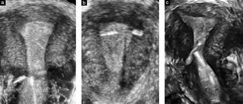 Three‐dimensional Ultrasound Detection Of Abnormally Located