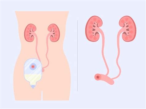 Urinary Diversion Surgery In Mumbai Neobladder And Stoma Care
