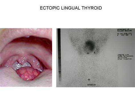 Ectopic Thyroid Endocrinesurgerynetau
