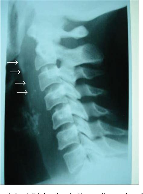 Bone Structure Of C4 Semantic Scholar
