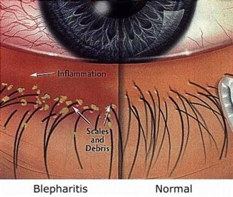 Dont Close Your Eyes To Blepharitis Symptoms