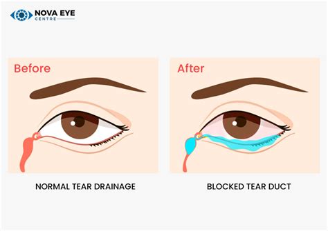 Blocked Tear Ducts Causes Signs And Treatment Okzaa