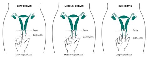 High Vs Low Cervix