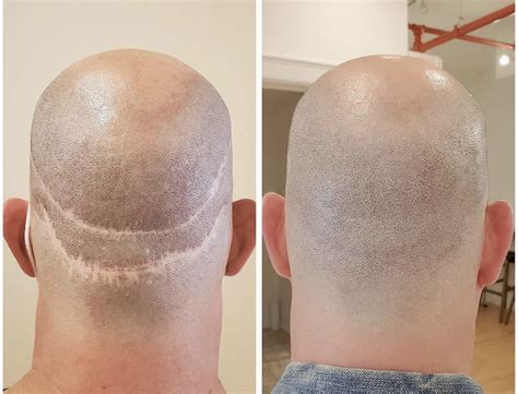 Hair Tattooing For Scar Camouflage Scalp Micro Usa