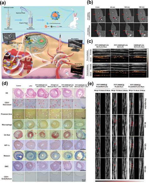 Advances In Atherosclerosis Theranostics Harnessing Iron Oxide‐based Nanoparticles Pmc