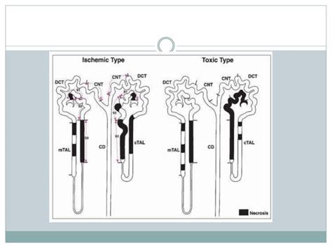 Acute Tubular Necrosis Pptx