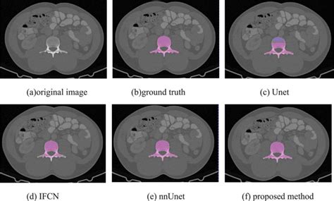 Horizontal Visualization Of Lumbar Vertebrae Segmentation Results Of Download Scientific