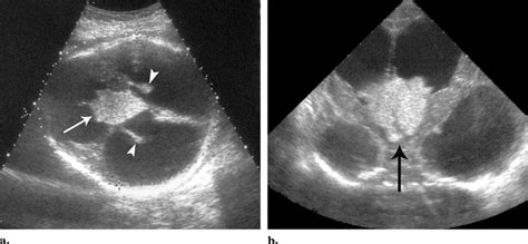 Choroid Plexus Papilloma A Axial Us Image Of A Fetal Brain Shows An