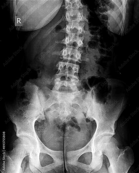 X Ray Of Idiopathic Scoliosis Of Lumbar Spine Part Of Adolescent Skeleton With Spinal Curvature