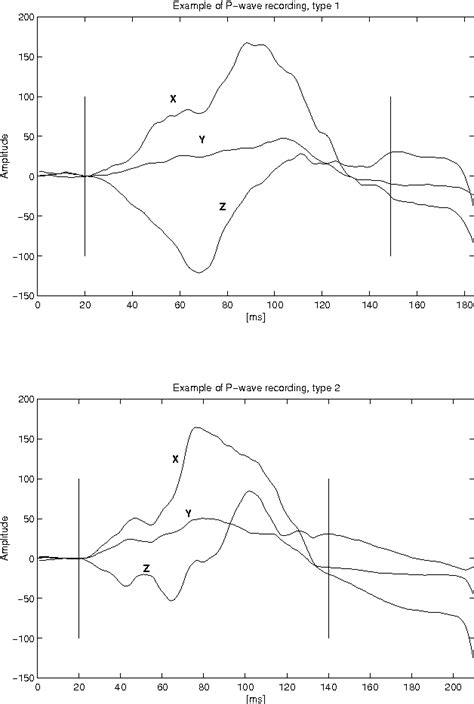 Figure 1 From Classification Of Electrocardiographic P Wave Morphology Semantic Scholar