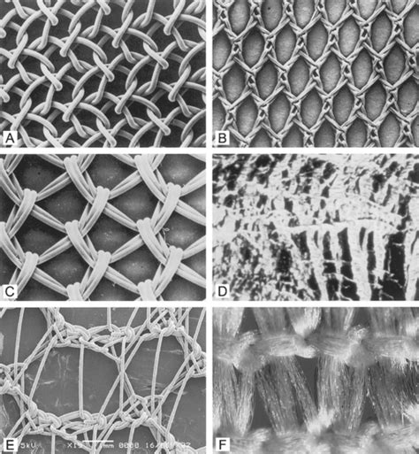 The Use Of Biologic Tissue And Synthetic Mesh In Urogynecology And Reconstructive Pelvic Surgery