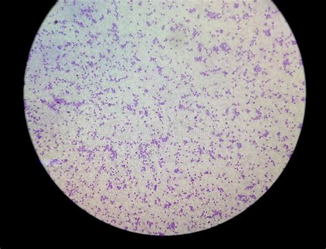 Essential Thrombocytosis Under Microscopy Abnormal High Volume Of