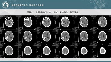 3dslicer指导自发性脑出血钻孔引流术应用体会 脑医汇 神外资讯 神介资讯