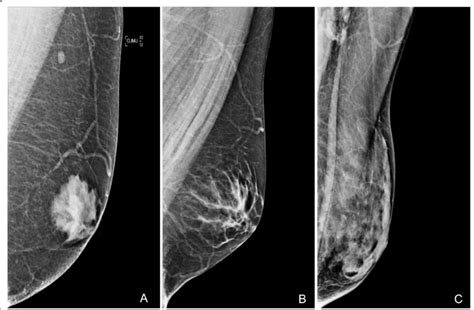 Radiologic Patterns In Gynecomastia A Nodular B Dendritic C Diffuse Download Scientific Diagram