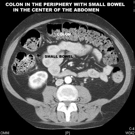 Bowel Obstruction Ileus