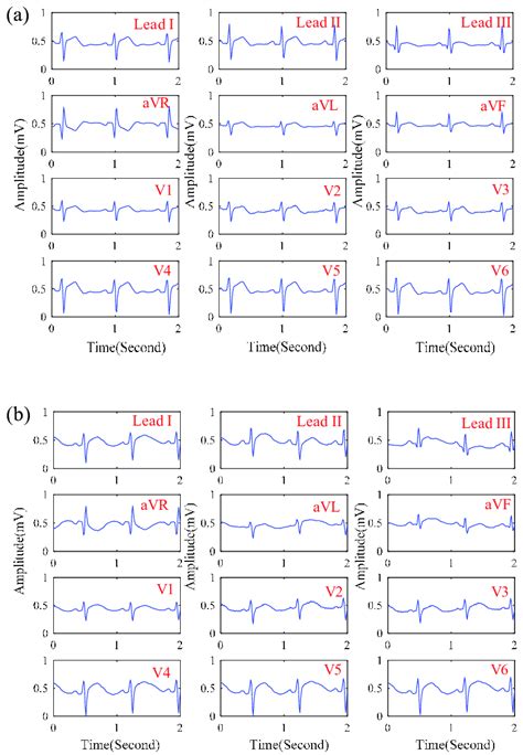 The 12 Lead Ecg Signals Obtained By The Proposed System When A Download Scientific Diagram