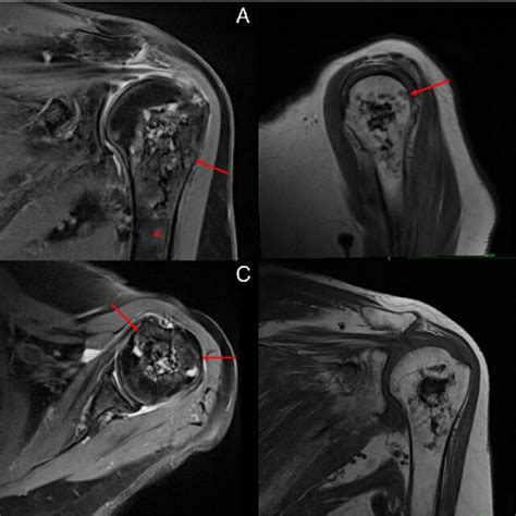 Mri Scan Of An Act Maximal Diameter Of 52 Cm Deep Endosteal