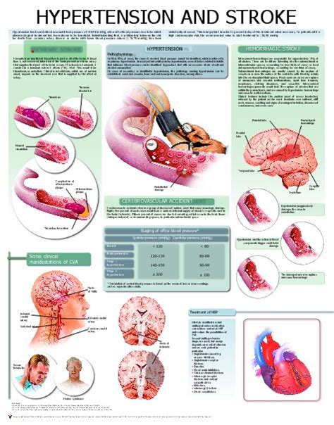 Hypertension And Stroke Anejo