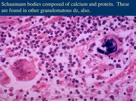 PPT Idiopathic Pulm Fibrosis IPF Chronic Interstitual Lung Dz Honeycombed Alveolar Spaces
