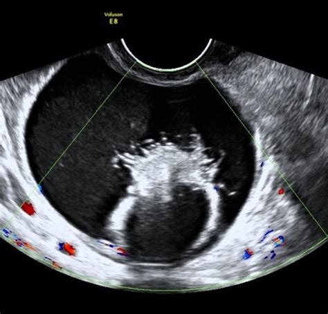 Cystic Teratoma Ultrasound