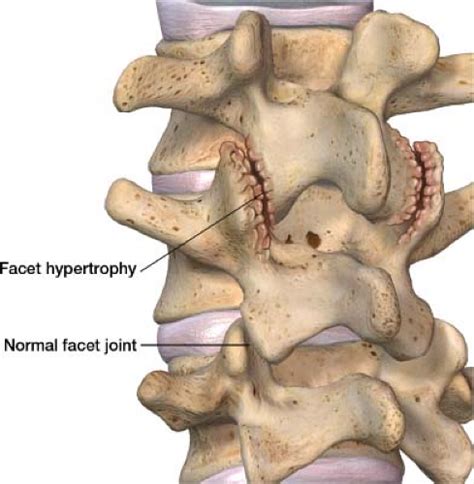 Facet Joint Procedures Facet Joint Injections Medial Branch Blocks And Radiofrequency