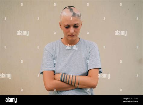 Real Alopecia Areata In A Young Girl A Bald Head In A Person Diffuse Alopecia Androgenic