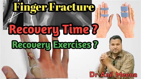 Broken Finger Recovery Time Finger Fracture Rehabilitation Lkhqt