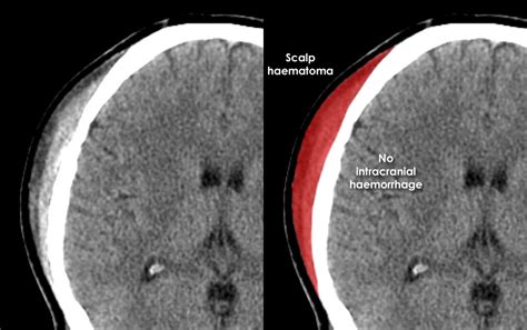 Acute Contusion Scalp