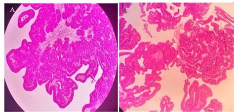 A B Tumor Cells In Inverted Growth Pattern In Form Cords And Sheets Download Scientific