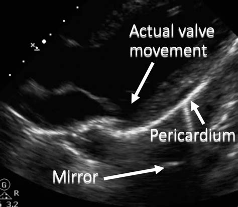 Artifacts In Ultrasound Edges And Mirrors