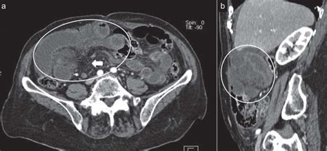 Internal Hernias A Difficult Diagnostic Challenge Review Of Ct Signs And Clinical Findings