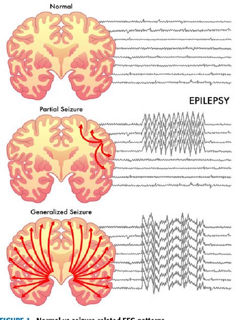 figure 1 from brain epileptic seizure detection using joint cnn and exhaustive feature selection
