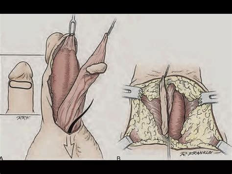 Single Stage Urethroplasty Using Penile Skin Flaps Pdf