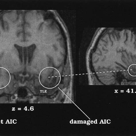 Resection Of Anterior Insular Cortex In The Outlier Left Coronal