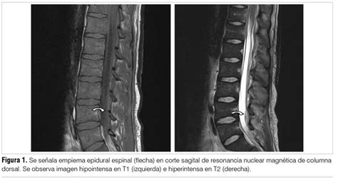 Empiema Epidural Espinal Clínica Diagnóstico Y Tratamiento A
