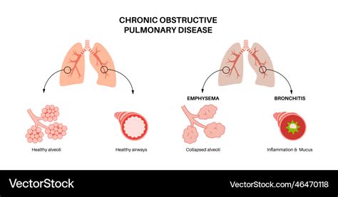Chronic Obstructive Pulmonary Disease Royalty Free Vector