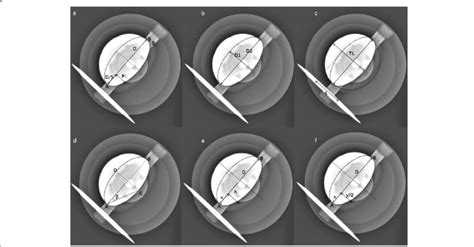 Methods For Measuring Anteversion On Plane Anteroposterior Radiographs
