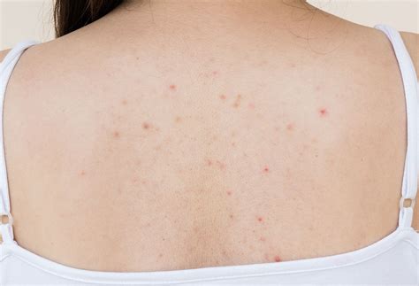 What Causes “bacne”—and How To Get Rid Of It The Well By Northwell