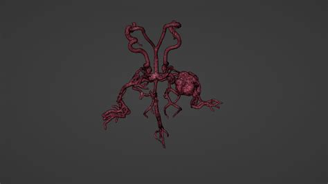 3d Model Of Middle Cerebral Artery Mca Aneurysm By Azekapeka
