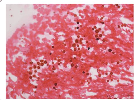 Cryptococcosis Were The Halo Like Narrow Necked Budding Yeast Cells Cryptococcosis Were The Halo Like Narrow Necked Budding Yeast Cells