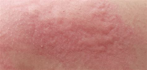 Types Of Skin Cancer With Rash Skin Cancer Rash Itchiness And Symptoms