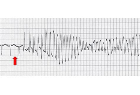 Syncope In An 18 Year Old Woman Case Presentation