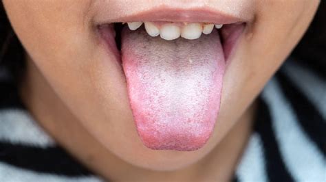Oral Thrush What Is It Symptoms Treatment Healthshots