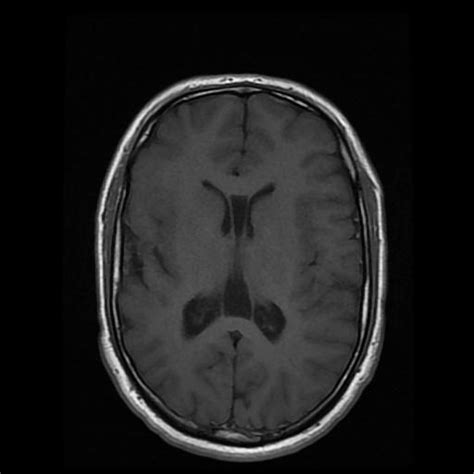 Polymicrogyria Image