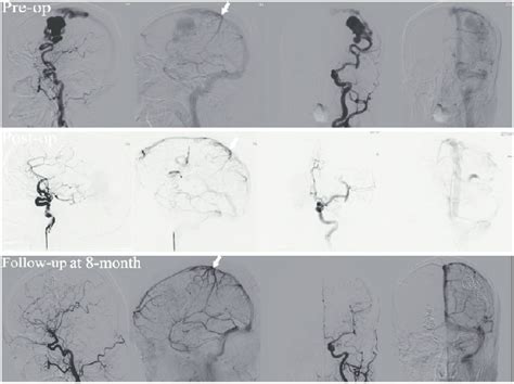 Pre And Postoperative Cerebral Angiogram Of The Left Mca Avf Arrows Download Scientific