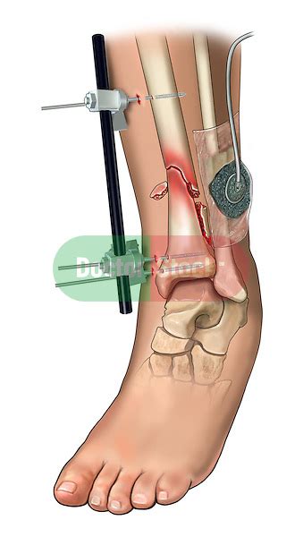 Orif Tib Fib Fracture Hardware Sefeti