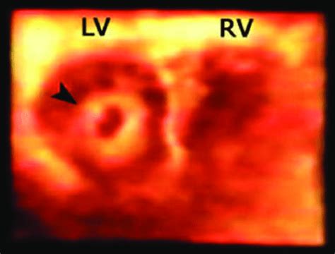 A Livereal Time Three Dimensional Transthoracic Echocardiography In Download Scientific